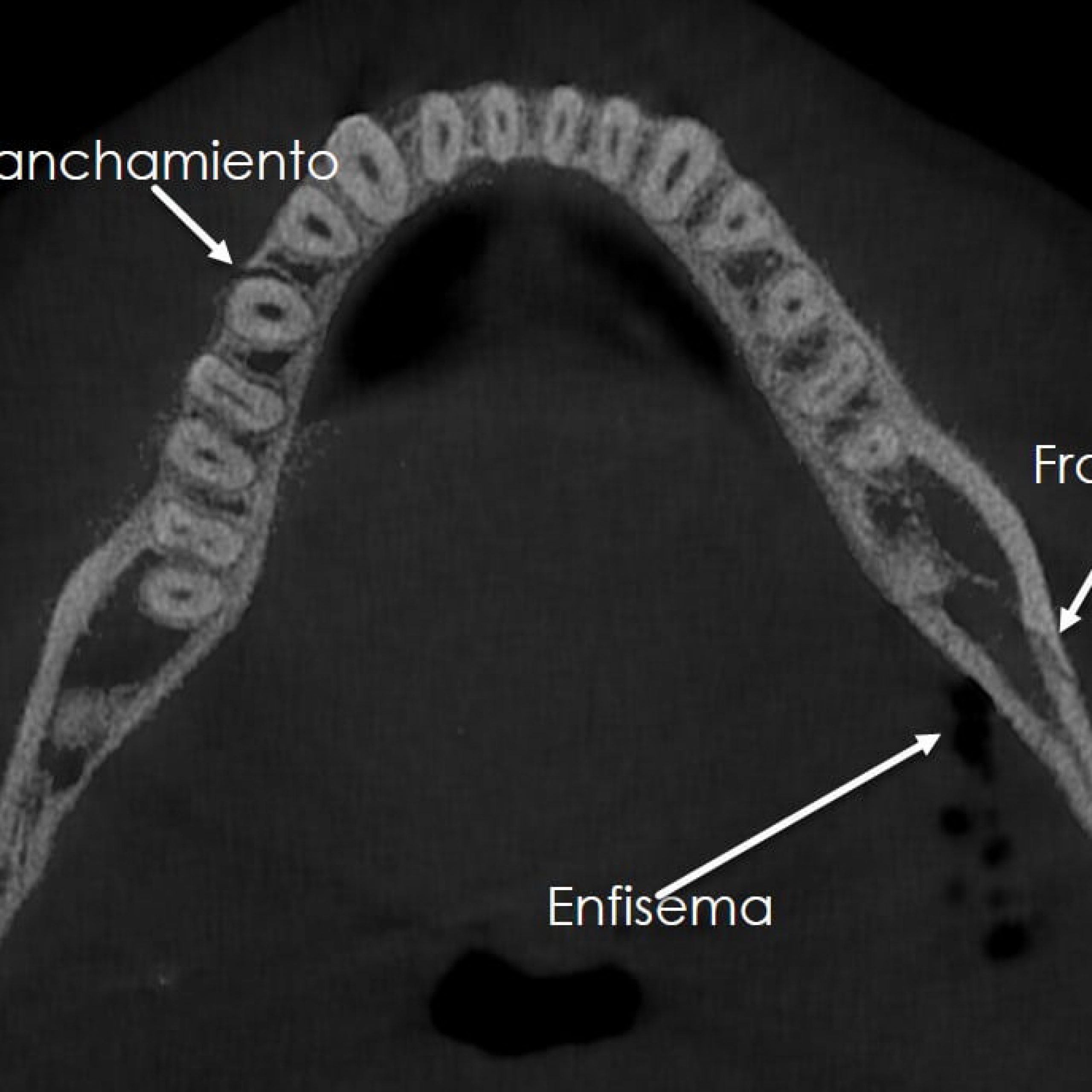 Fractura Mandibular Múltiple – Dento Metric | Radiología Dental, Oral y ...