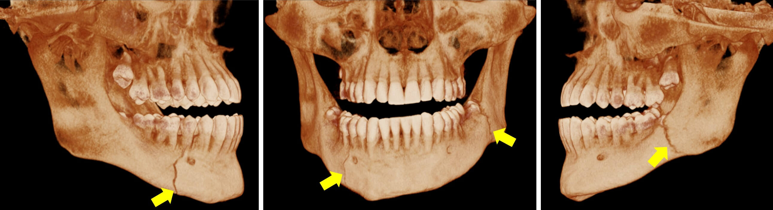 Orbitomalar
