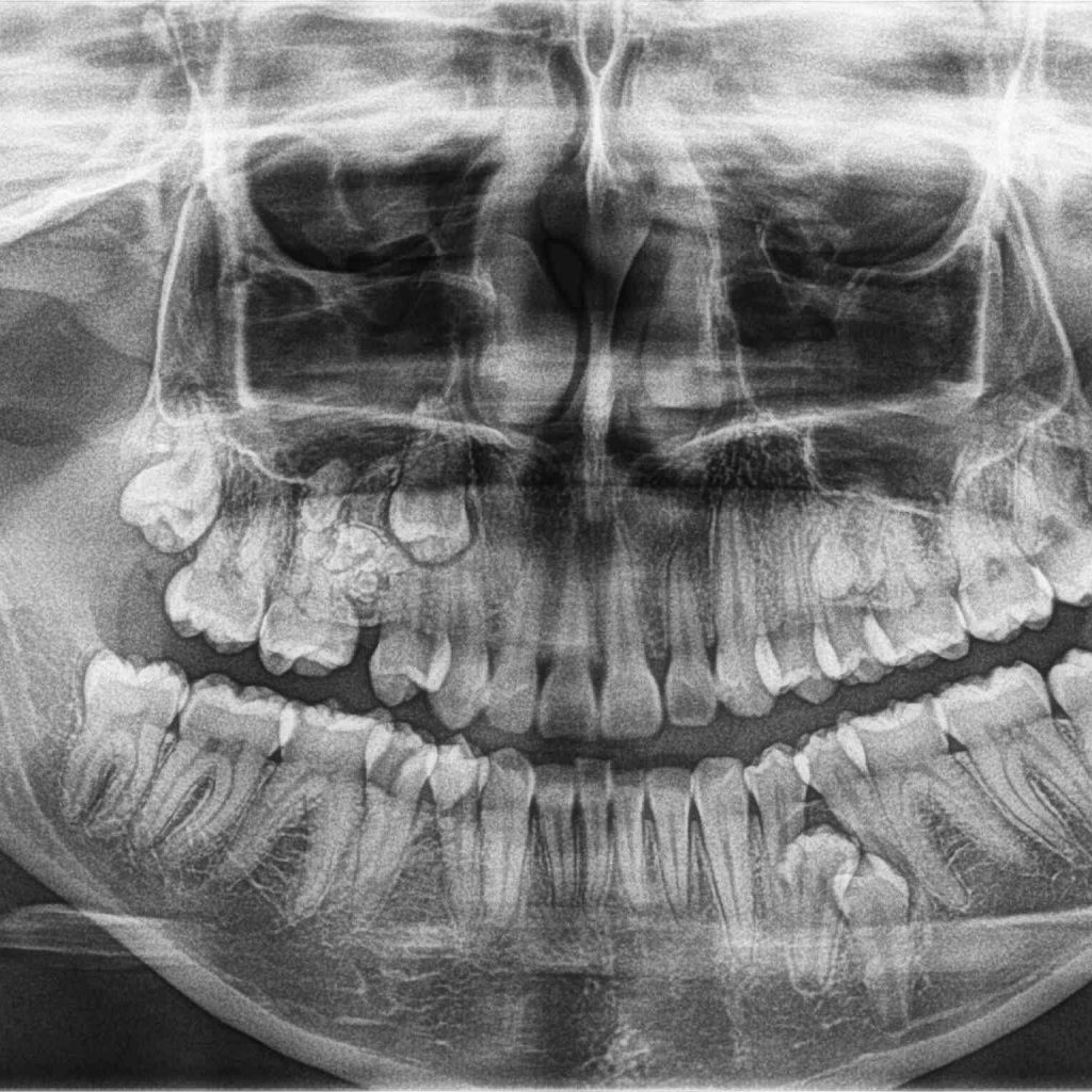 Odontoma Compuesto – Dento Metric | Radiología Dental, Oral y Maxilofacial