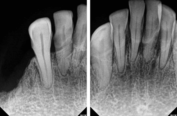 Enfermedad Periodontal Generalizada – Dento Metric | Radiología Dental ...