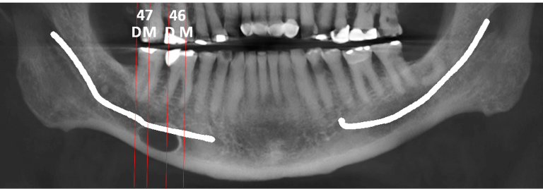Defecto Óseo de Stafne – Dento Metric | Radiología Dental, Oral y ...