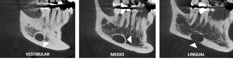 Defecto Óseo de Stafne – Dento Metric | Radiología Dental, Oral y ...