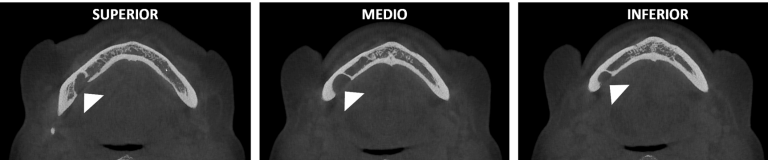 Defecto Óseo de Stafne – Dento Metric | Radiología Dental, Oral y ...