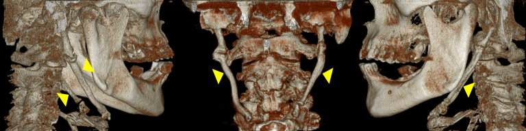 Calcificación Pseudoarticular Del Ligamento Estilohioideo Dento