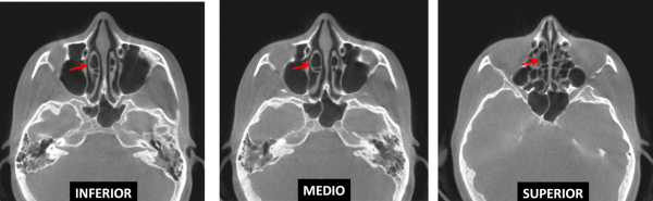 Concha Bullosa – Dento Metric | Radiología Dental, Oral y Maxilofacial