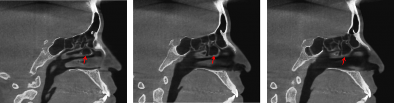 Concha Bullosa – Dento Metric | Radiología Dental, Oral y Maxilofacial
