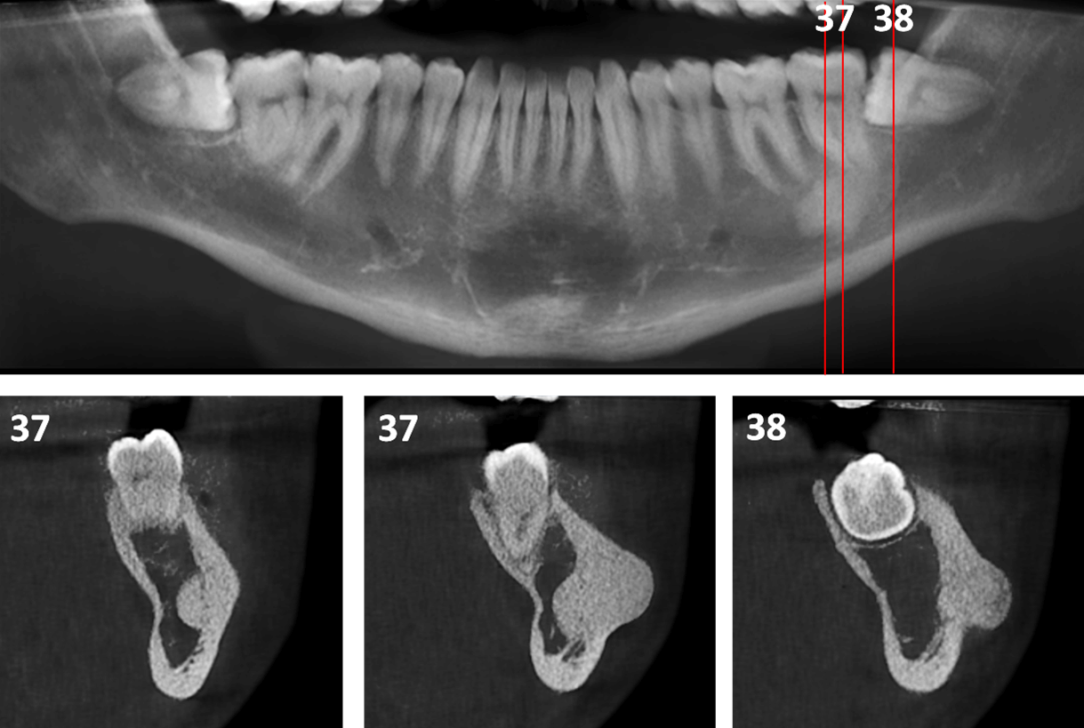 Osteoma Perif rico En Mand bula Dento Metric Radiolog a Dental Osteoma Perif rico En Mand bula Dento Metric Radiolog a Dental