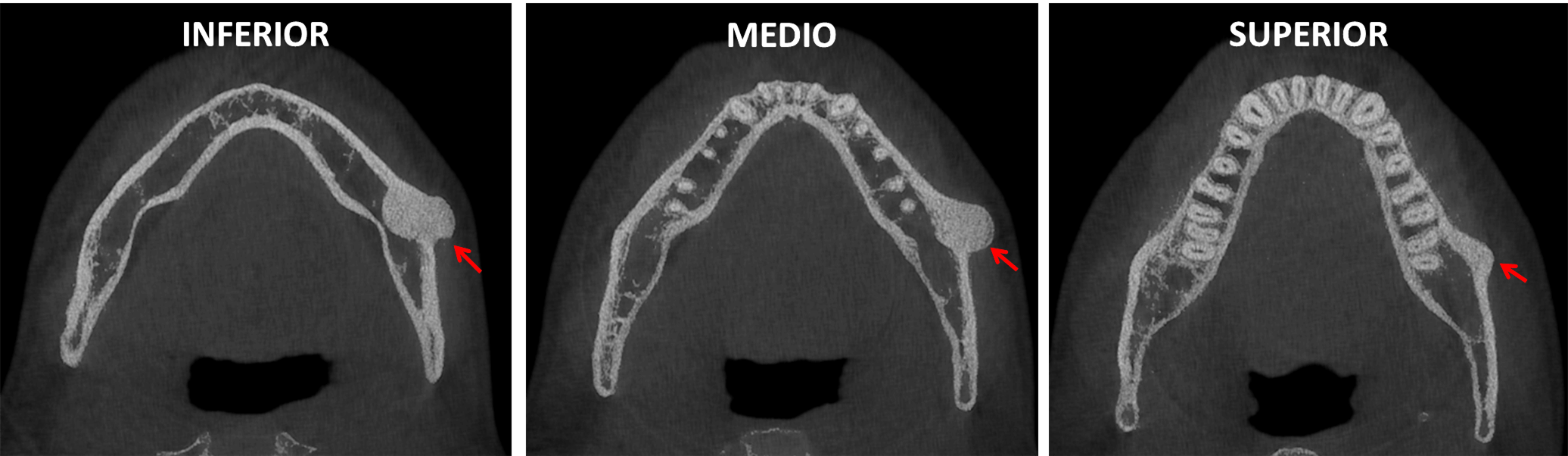 Osteoma Perif rico En Mand bula Dento Metric Radiolog a Dental Osteoma Perif rico En Mand bula Dento Metric Radiolog a Dental