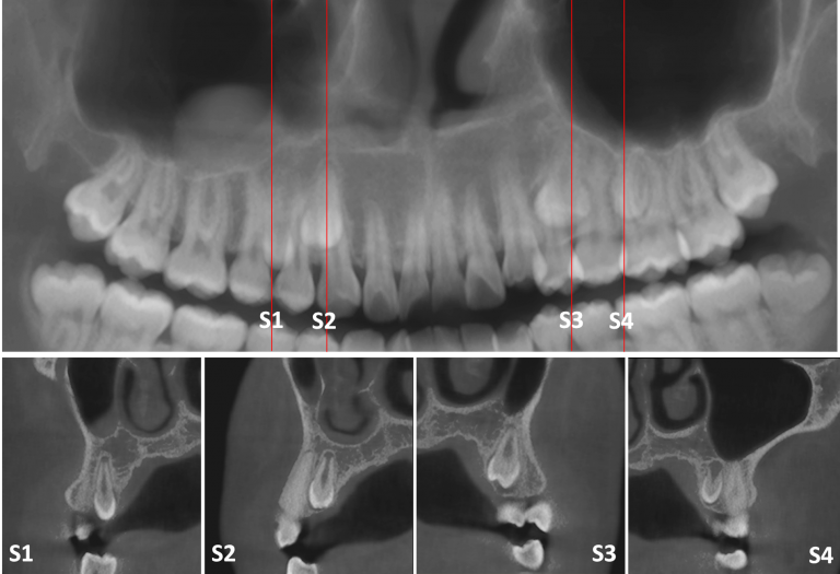 Múltiples Dientes Supernumerarios – Dento Metric | Radiología Dental ...