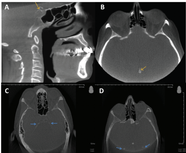 Revisión De Artículo 14 Dento Metric Radiología Dental Oral Y