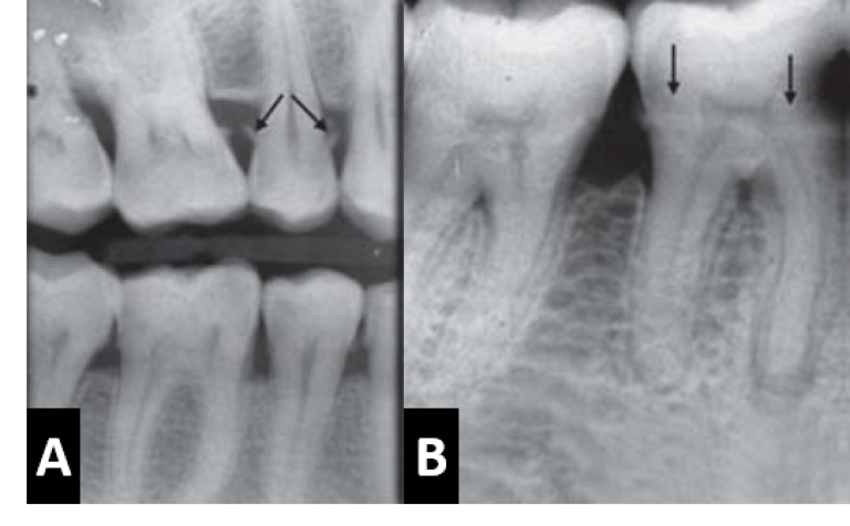 Signos Radiográficos de la Enfermedad Periodontal – Dento Metric ...
