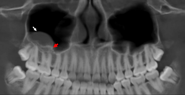 Antrolitos en el seno maxilar derecho – Dento Metric | Radiología ...