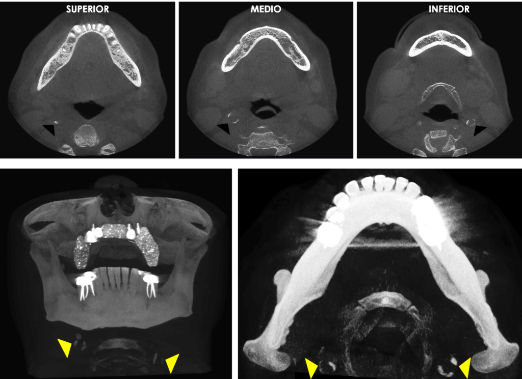 Aplicaciones De La Tomografía Para Cirugía Maxilofacial Dento Metric