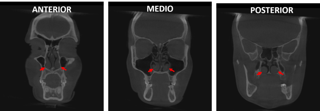 Hipertrofia del cornete nasal inferior – Dento Metric | Radiología ...