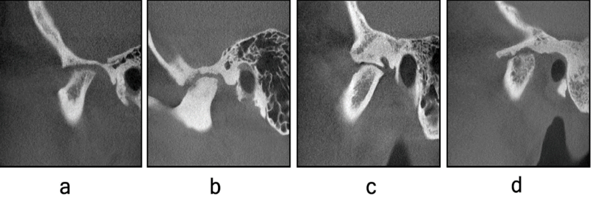 Aplicaciones de la Tomografía de ATM – Dento Metric | Radiología Dental ...