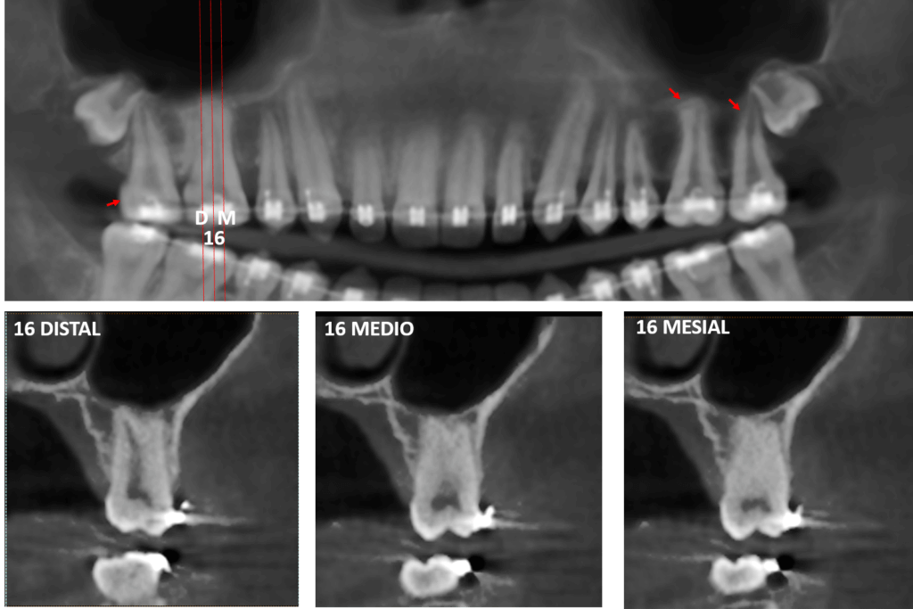 Taurodontismo en molares superiores – Dento Metric | Radiología Dental ...