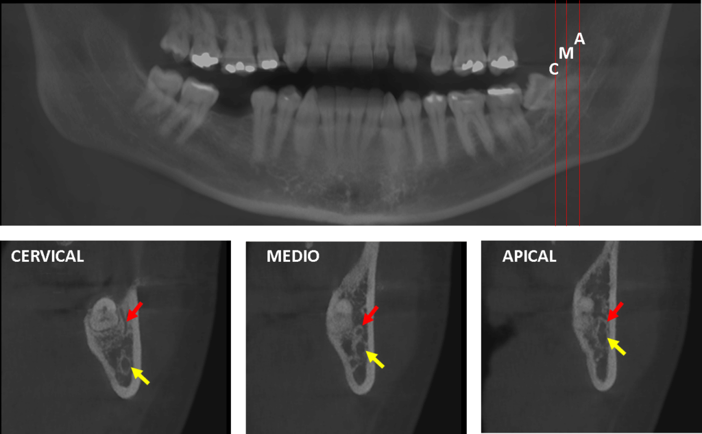 Conducto Retromolar – Dento Metric | Radiología Dental, Oral y Maxilofacial