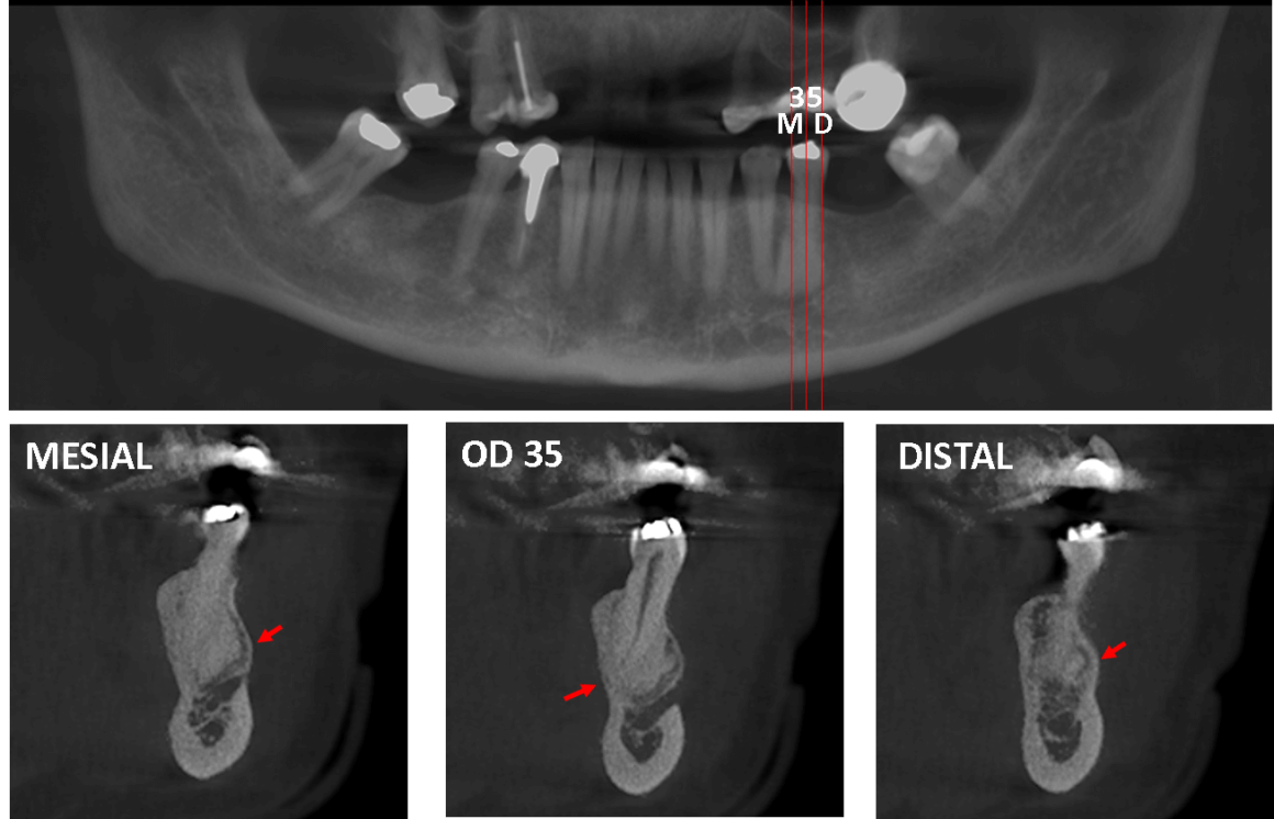 Cementoblastoma asociado a un premolar mandibular – Dento Metric ...