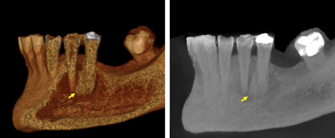 Cementoblastoma asociado a un premolar mandibular – Dento Metric ...