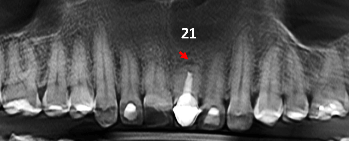 Perforación radicular por endodoncia en un incisivo central superior ...