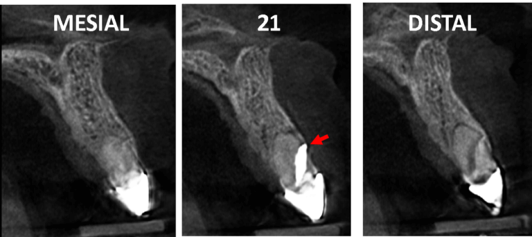 Perforación radicular por endodoncia en un incisivo central superior ...