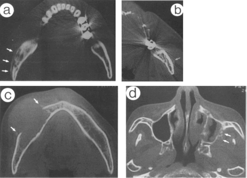 Reacción periostal en los huesos maxilares – Dento Metric | Radiología ...