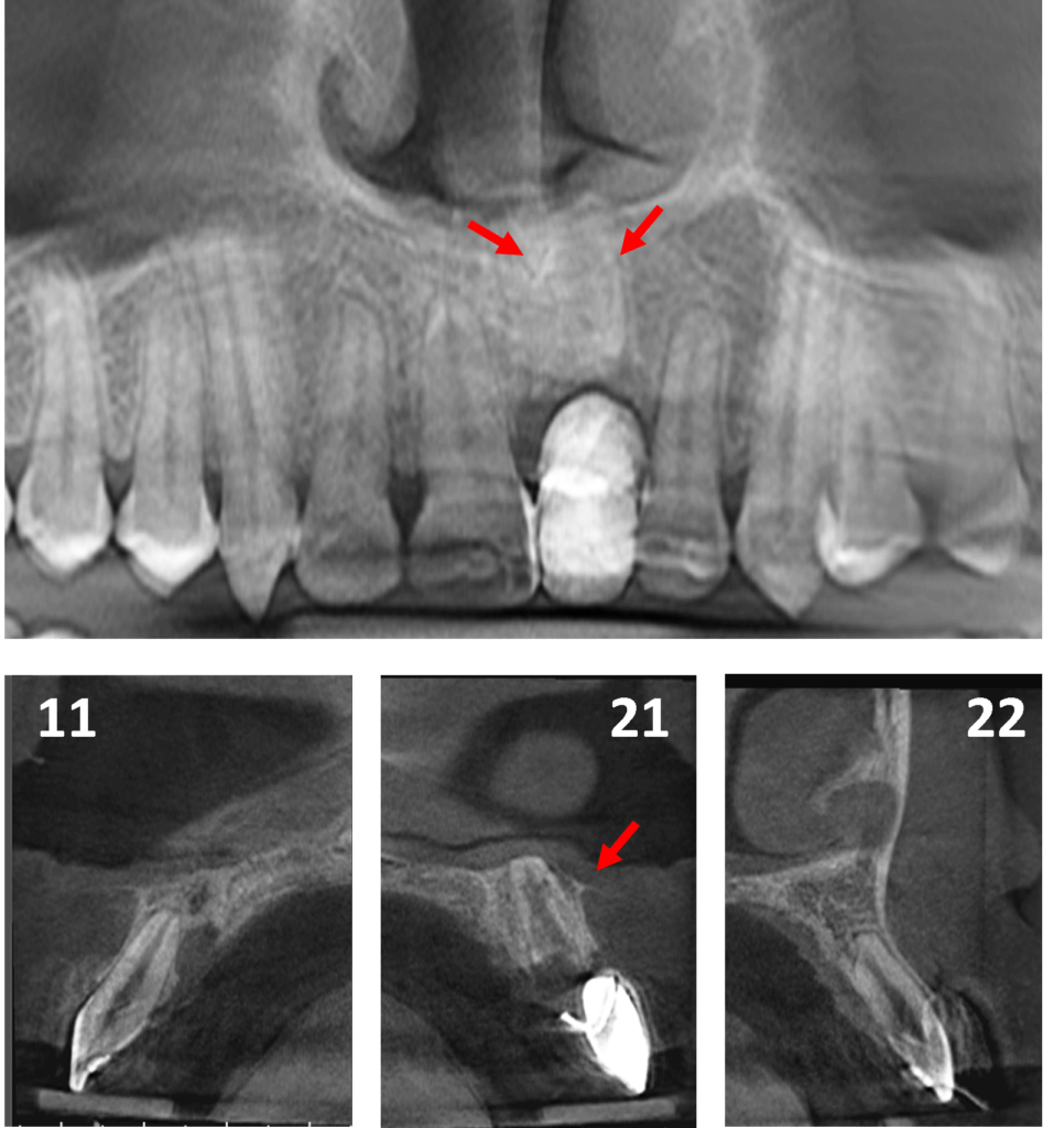 Luxación intrusiva de un incisivo central superior – Dento Metric ...