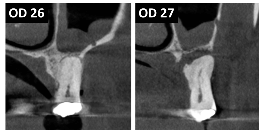 Concrescencia e Hipercementosis en molares superiores – Dento Metric ...