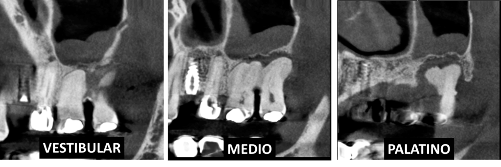 Concrescencia e Hipercementosis en molares superiores – Dento Metric ...