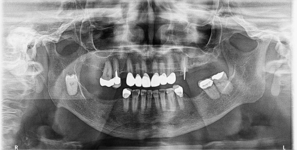 Tercer molar en rama ascendente mandibular – Dento Metric | Radiología ...