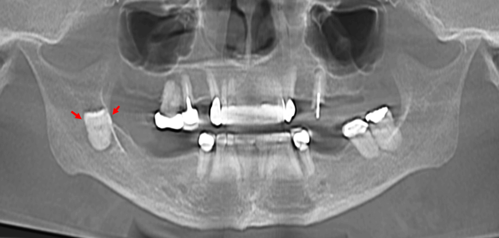 Tercer molar en rama ascendente mandibular – Dento Metric | Radiología ...