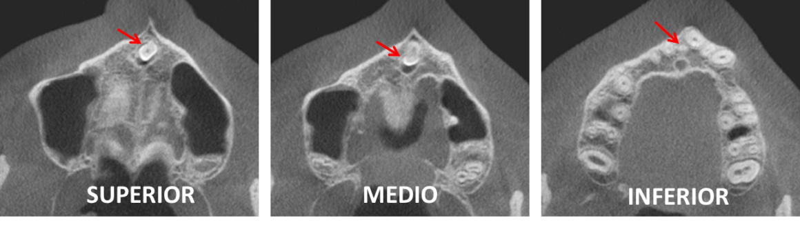 Mesiodens comprometiendo el conducto nasapalatino – Dento Metric ...