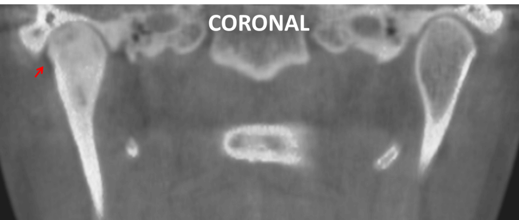 Osteítis Subcondral en la ATM – Dento Metric | Radiología Dental, Oral ...