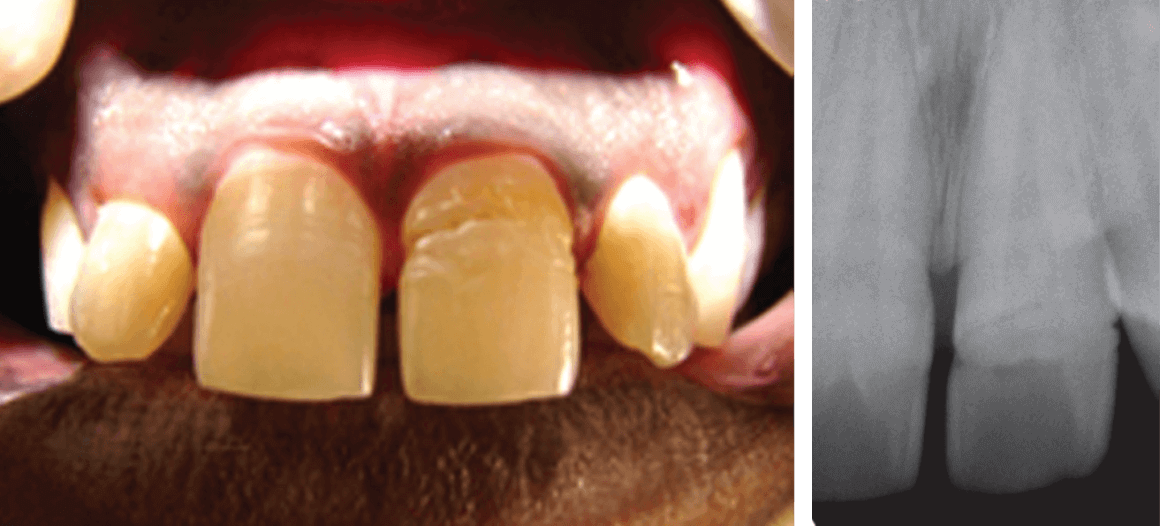 Hipoplasia del esmalte (Diente de Turner) – Dento Metric | Radiología ...