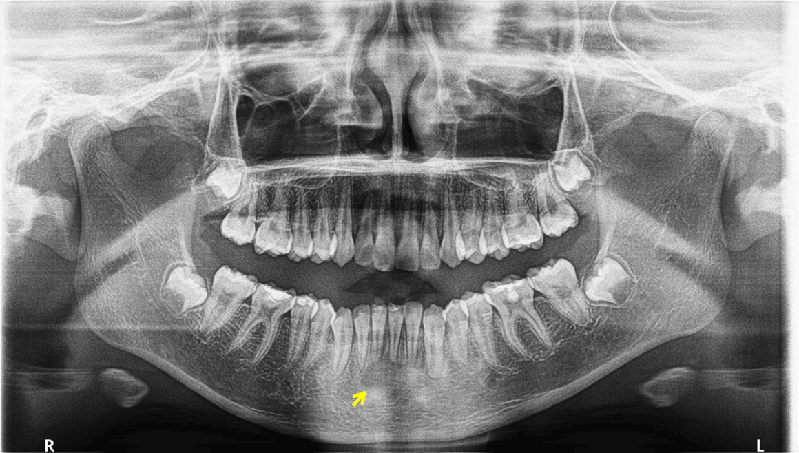 Doble conducto radicular en incisivos inferiores – Dento Metric ...