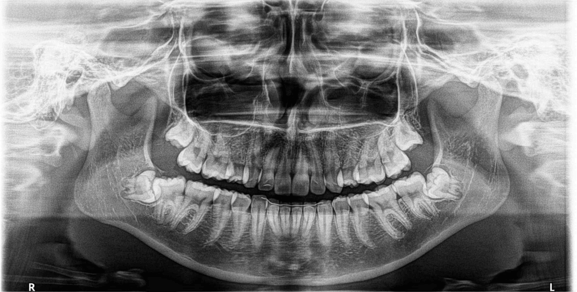 Impactación de un tercer molar asociado a la retención secundaria de un ...
