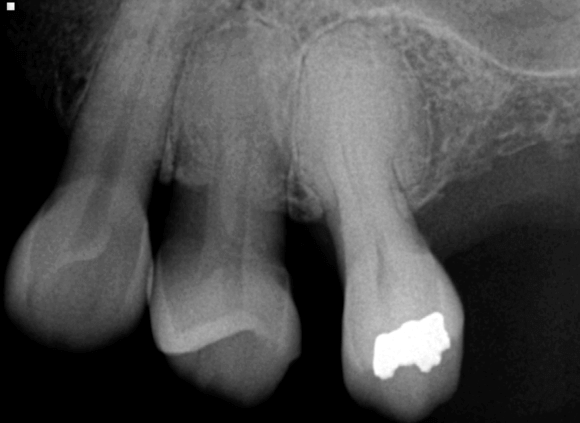 Lesiones radiopacas frecuentes en los maxilares – Dento Metric ...