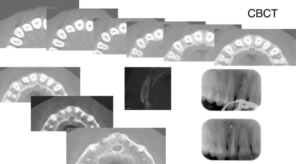Surco palatogingival y su relevancia clínica – Dento Metric ...