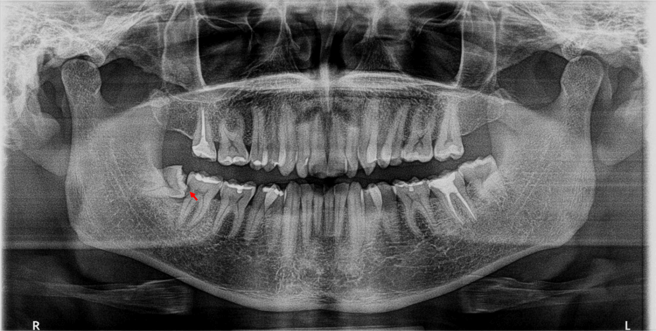 Caries por impactación dentaria – Dento Metric | Radiología Dental ...