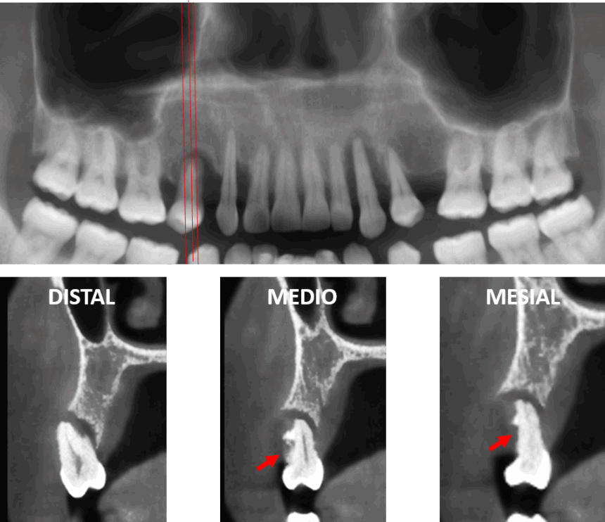 Reabsorción radicular externa en un premolar superior – Dento Metric ...