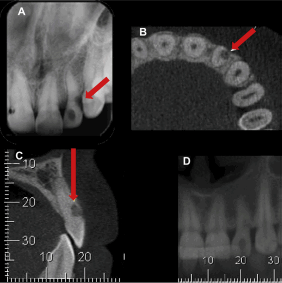 Rizólisis de origen inflamatorio – Dento Metric | Radiología Dental ...